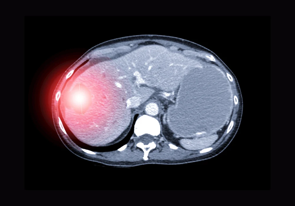 Assessing Liver Function with Multiphase Hepatic CT