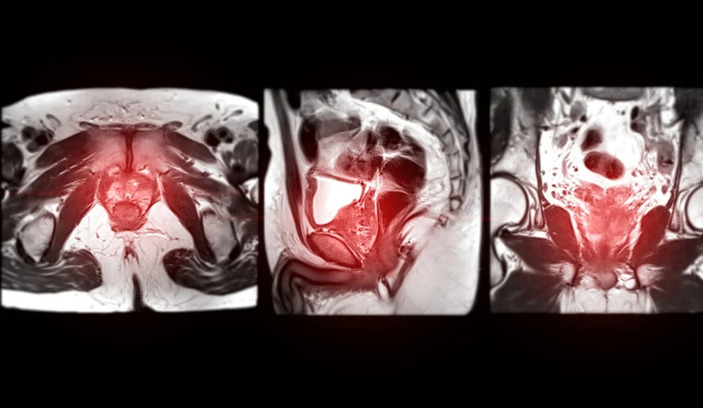 Optimising Gadolinium Use in Prostate MRI Through On-Table Monitoring