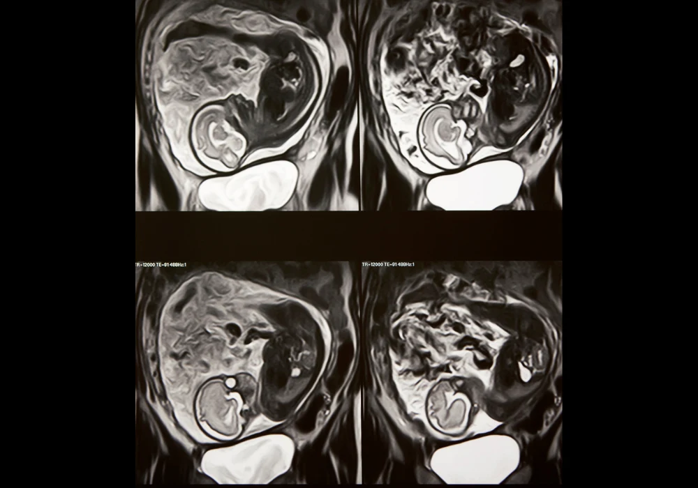 Radiation-Free MRI for Obstetric Pelvimetry