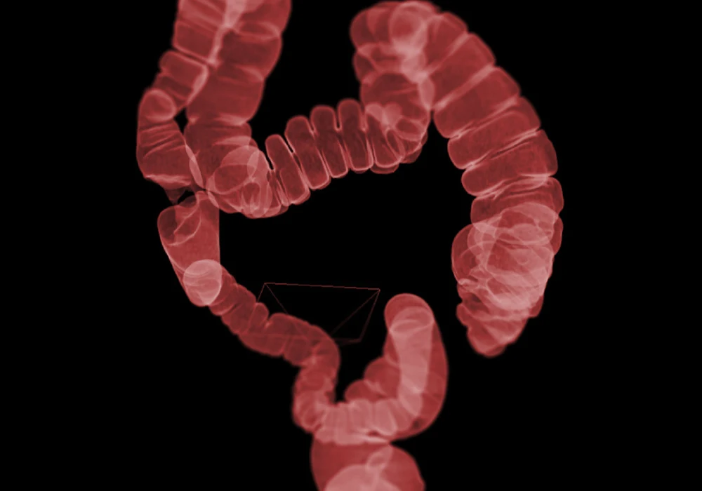 CT Colonography Offers Superior Value in Bowel Cancer Screening