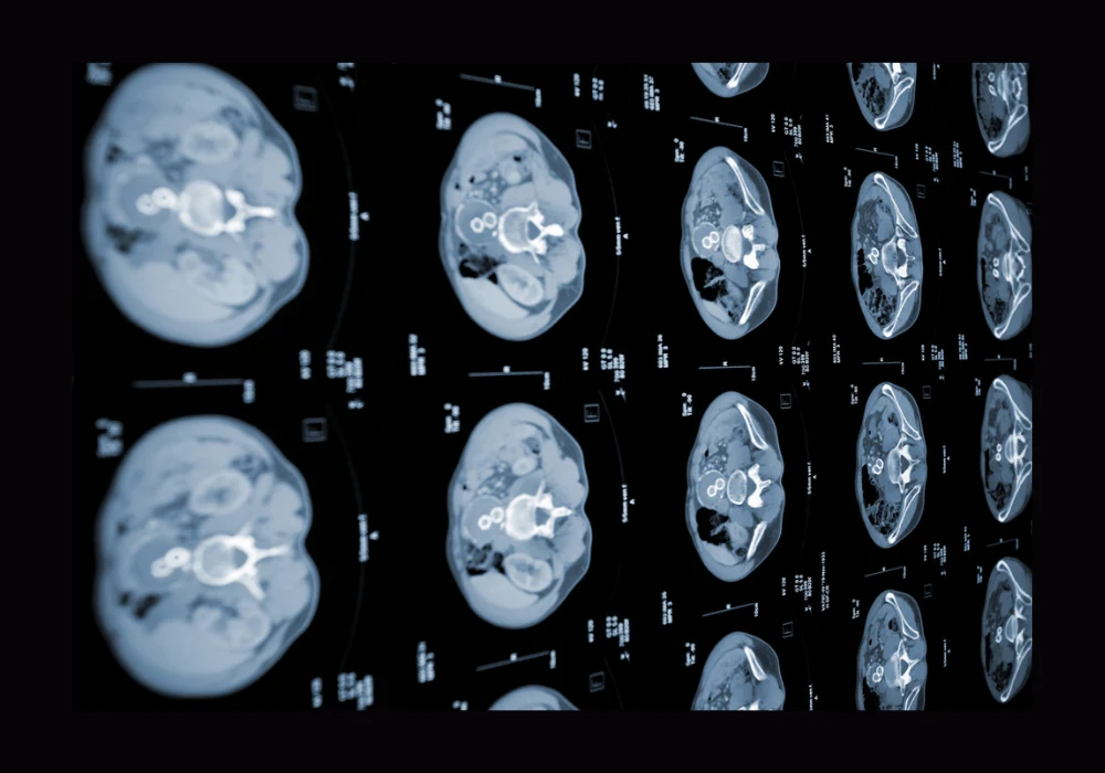 Imaging the Vanishing Pancreas