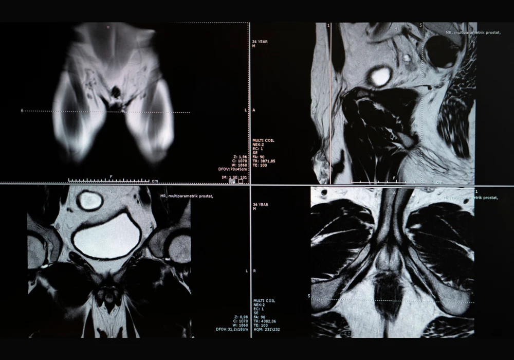 Abbreviated MRI in Prostate Cancer Screening