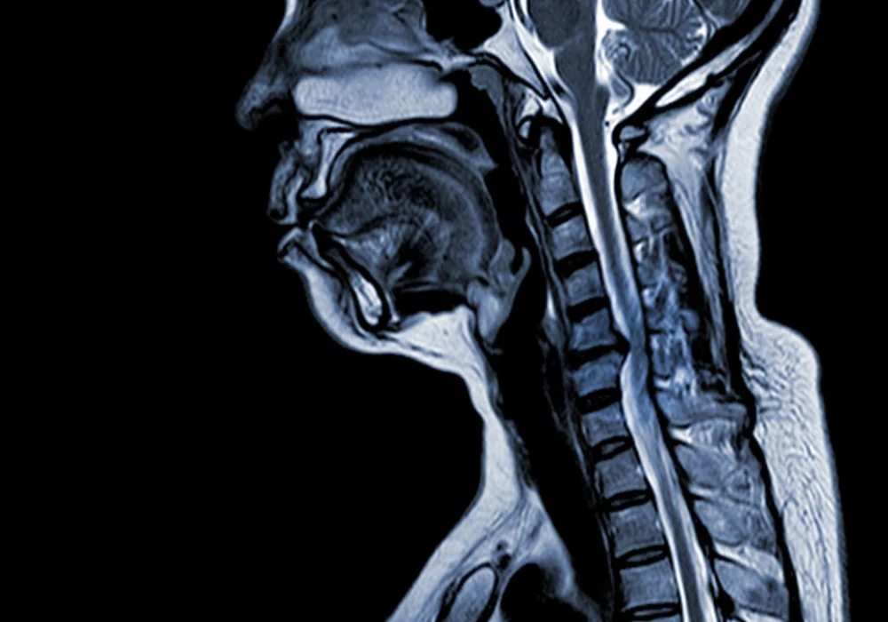 Diffusion–Relaxation MRI Predicts Nodal Risk in Tongue Cancer