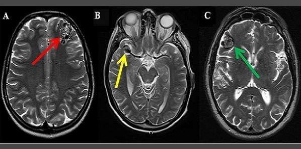 MRI + Prostate-Specific Antigen Screening Improves Cancer Detection ...