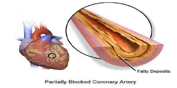 Nonobstructive CAD Linked to Higher Risk of Heart Attack, Death ...