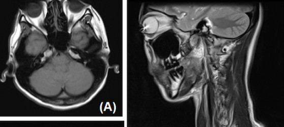 Brain Imaging After Mild Head Injury/Concussion Can Show Lesions ...