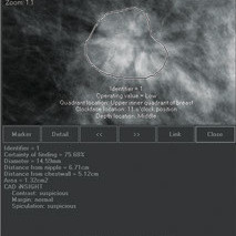 ECR2016: iCAD Unveils Tomosynthesis CAD Tool For Early Identification ...