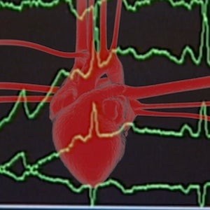 New Guidelines: Surgical Ablation Can Reduce Afib - HealthManagement.org