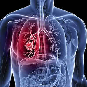 Lung-RADS: Potential Drawbacks and Need for Revision - HealthManagement.org