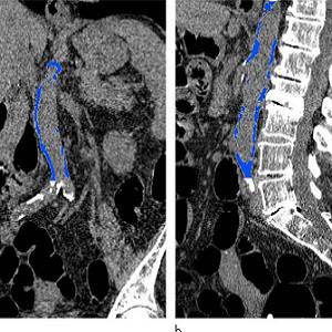 CT-based abdominal aortic calcification can predict heart attack ...