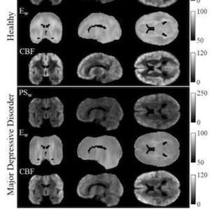 MRI findings provide fresh insights into MDD - HealthManagement.org