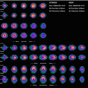 Nuclear Stress Test Identifies Heart Attack Risk in Diabetics