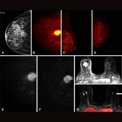 Breast Cancer: Low-Dose PEM Alongside MRI Could Improve Detection and ...