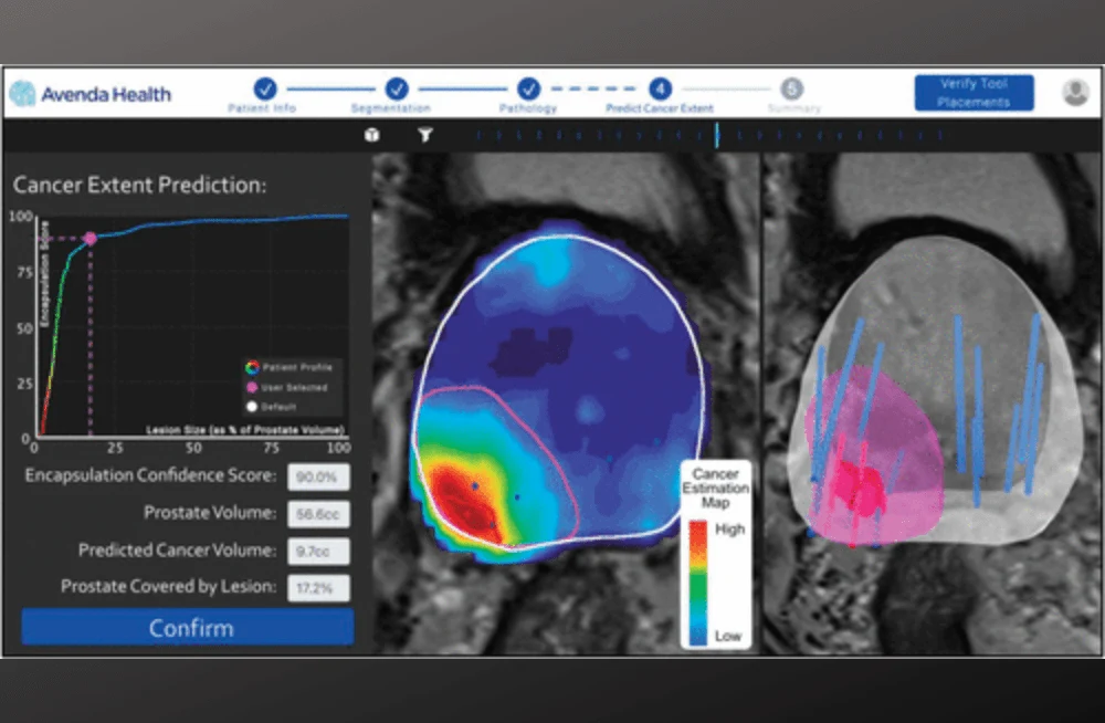 Improving Prostate Cancer Treatment Through AI-Assisted Contouring