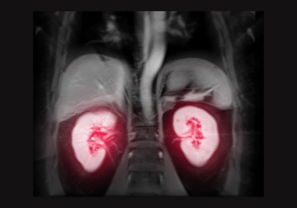 Novel T2 Mapping Techniques for Characterizing Renal Tumours