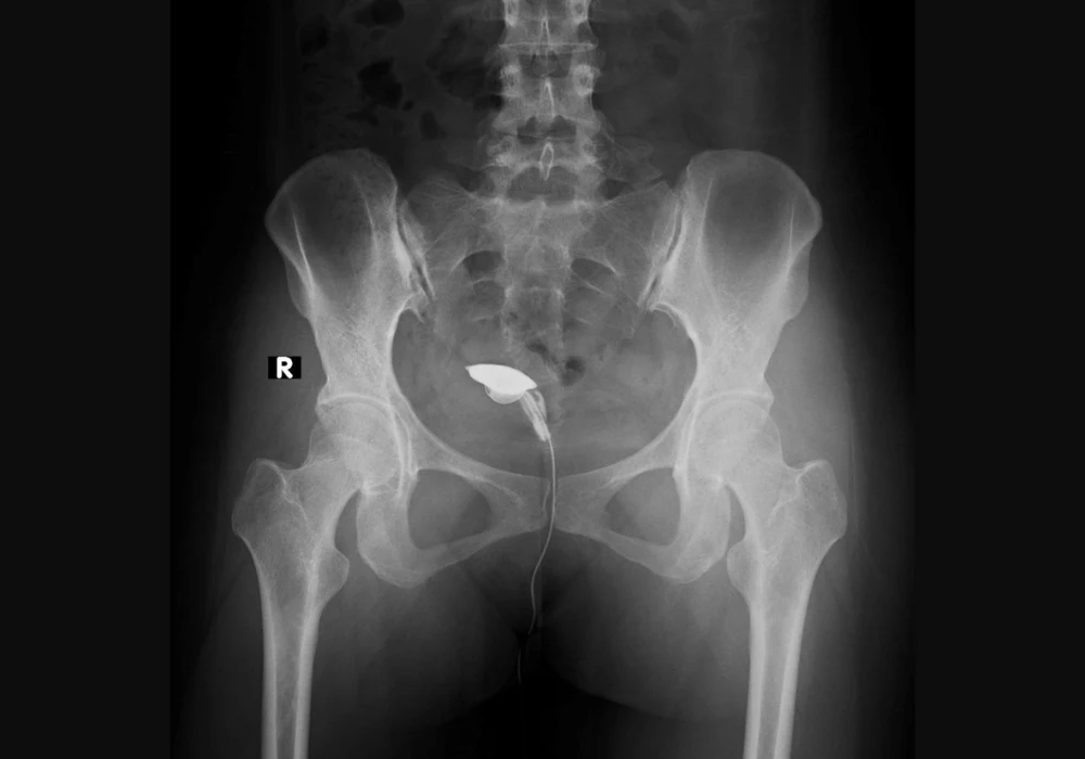 Use of Contrast Media in Hysterosalpingography: ESUR New Guidelines