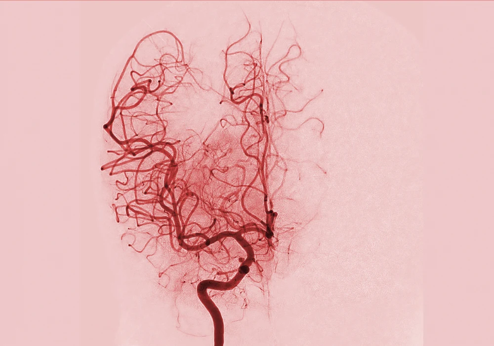 Advancing Cerebral Artery Imaging with 4D CTA