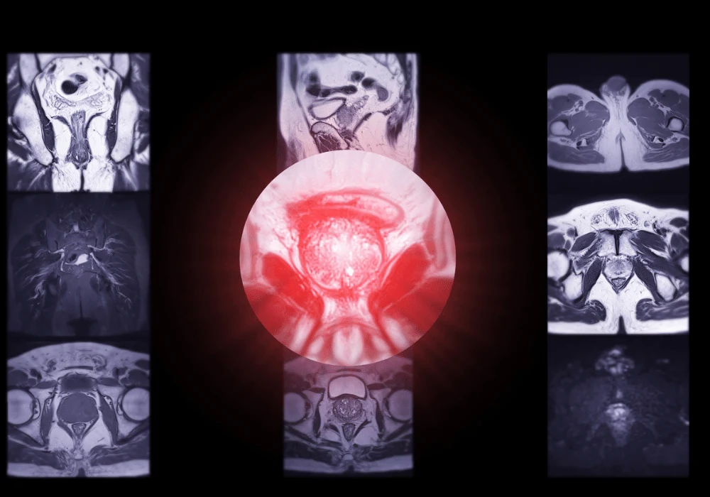 Advancing Prostate Cancer Diagnosis: Ultra-High Gradient MRI in Practice