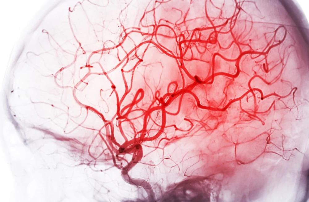 Ultra-low-dose Coronary CT with Deep Learning Reconstruction