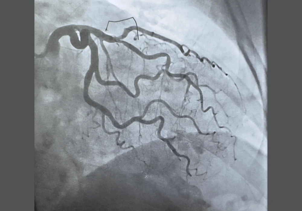 Enhanced Coronary Calcium Detection with Dual-Energy Radiography
