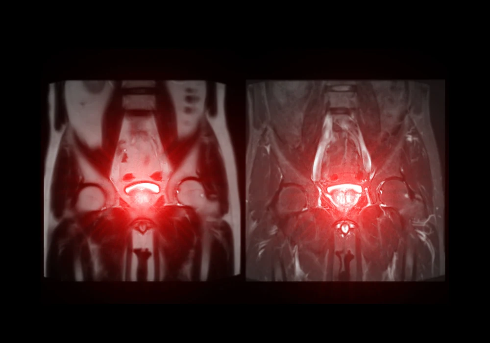 Faster Prostate MRI with Improved Image Quality