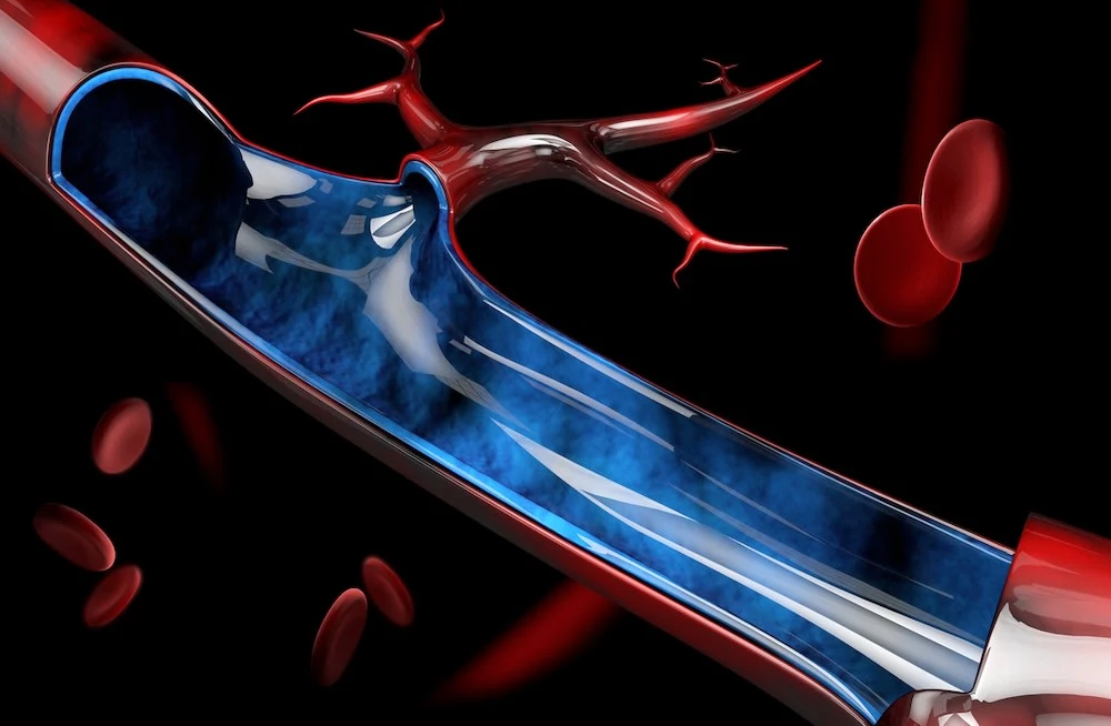 Intravenous Tenecteplase Before Endovascular Thrombectomy