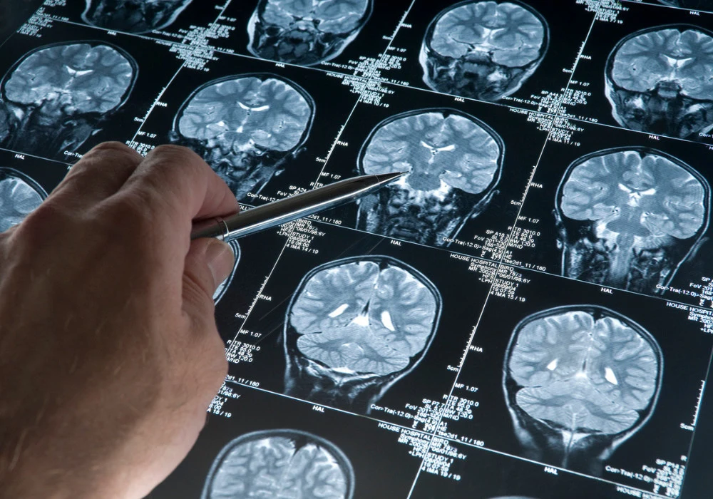 Accelerated Brain MRI for Memory Loss Assessment