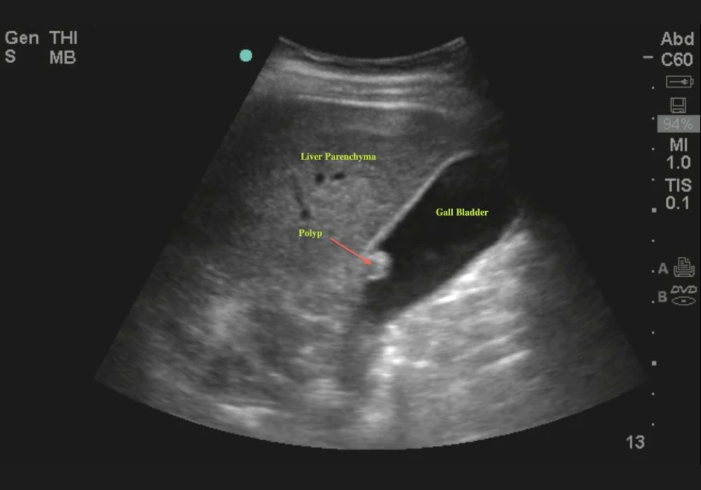 Imaging Pathways in Acute Acalculous Cholecystitis