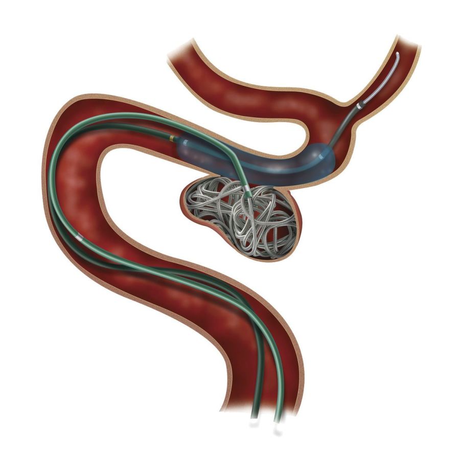 Health Management and Leadership Portal | Embolization coil hydrogel ...