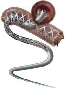 Health Management and Leadership Portal | Catheter guidewire ...