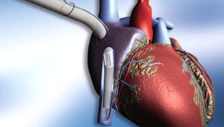 Health Management and Leadership Portal | Intra-aortic catheter ...