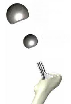 Health Management and Leadership Portal | Femoral head prosthesis ...