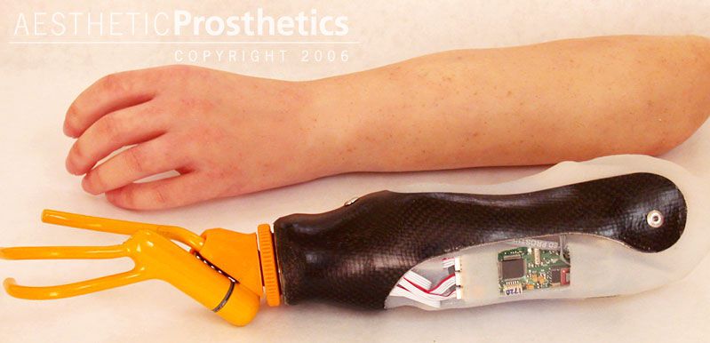 Health Management and Leadership Portal | Hand prosthesis (upper ...