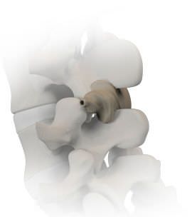 Health Management and Leadership Portal | Cervical interbody fusion ...