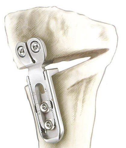 Health Management and Leadership Portal#N#| Tibia osteotomy plate OSTEO ...