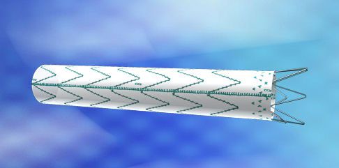 Health Management and Leadership Portal | Thoracic stent graft Hercules ...