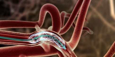 Health Management and Leadership Portal | Intracranial stent APOLLO ...