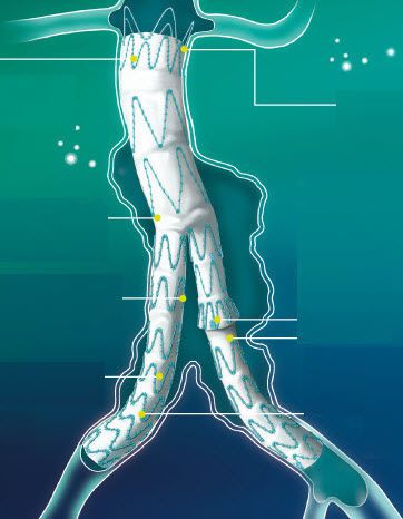Health Management and Leadership Portal | Coronary stent / drug eluting ...
