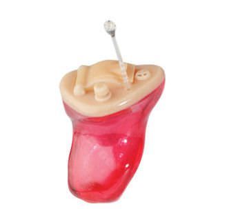 Health Management and Leadership Portal | Full shell (ITE) hearing aid ...