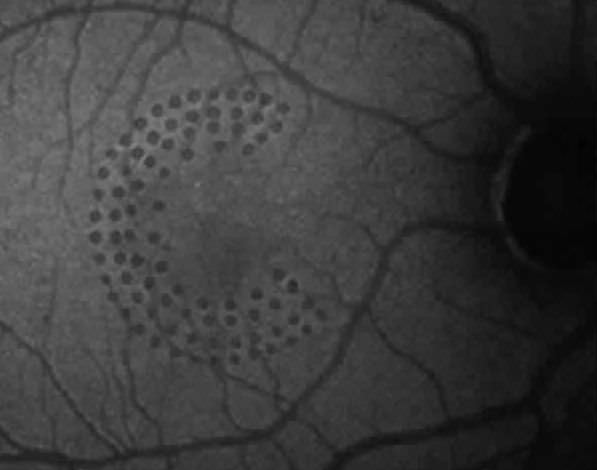 Health Management and Leadership Portal | Retinal photocoagulation ...