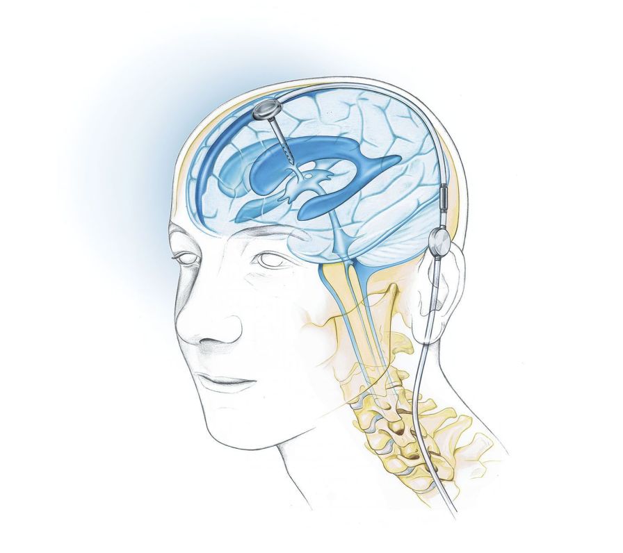 Health Management and Leadership Portal | Hydrocephalus shunt valve ...