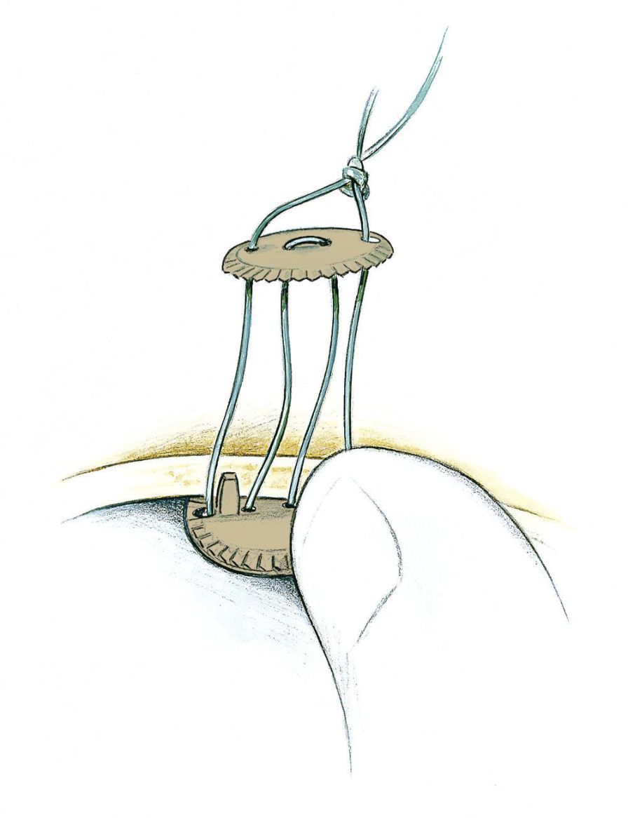 Health Management and Leadership Portal | Skull surgery clamp CranioFix ...