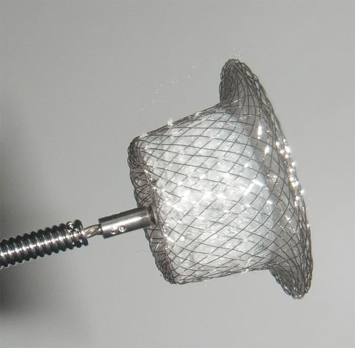 Health Management and Leadership Portal | Ventricular septal defect ...