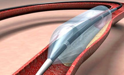 Health Management and Leadership Portal | PTCA catheter / balloon ...