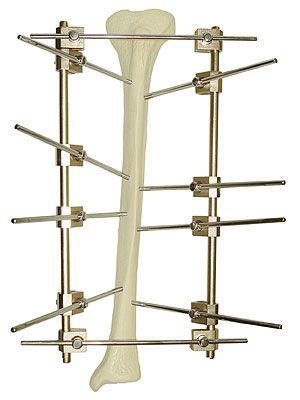 Health Management and Leadership Portal | Human external fixation ...