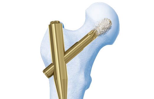 Health Management and Leadership Portal | Catheter guidewire / small ...