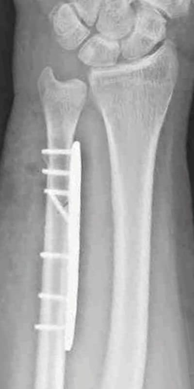 Health Management and Leadership Portal | Ulna compression bone plate ...