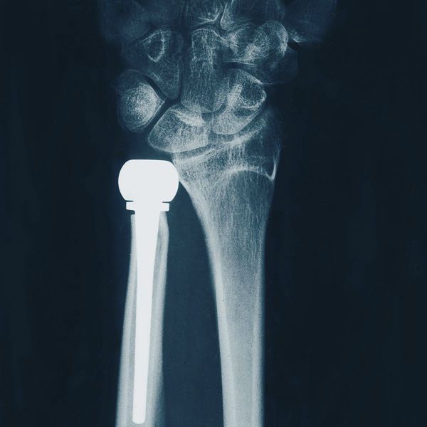 Health Management and Leadership Portal | Ulnar head prosthesis UHP KLS ...