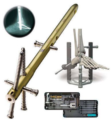 Health Management and Leadership Portal | Foot compression bone plate ...