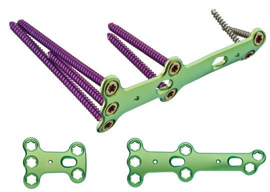 Health Management and Leadership Portal | Foot compression bone plate ...